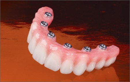 Fixed Implant Dentures - Tulsa Precision Dental
