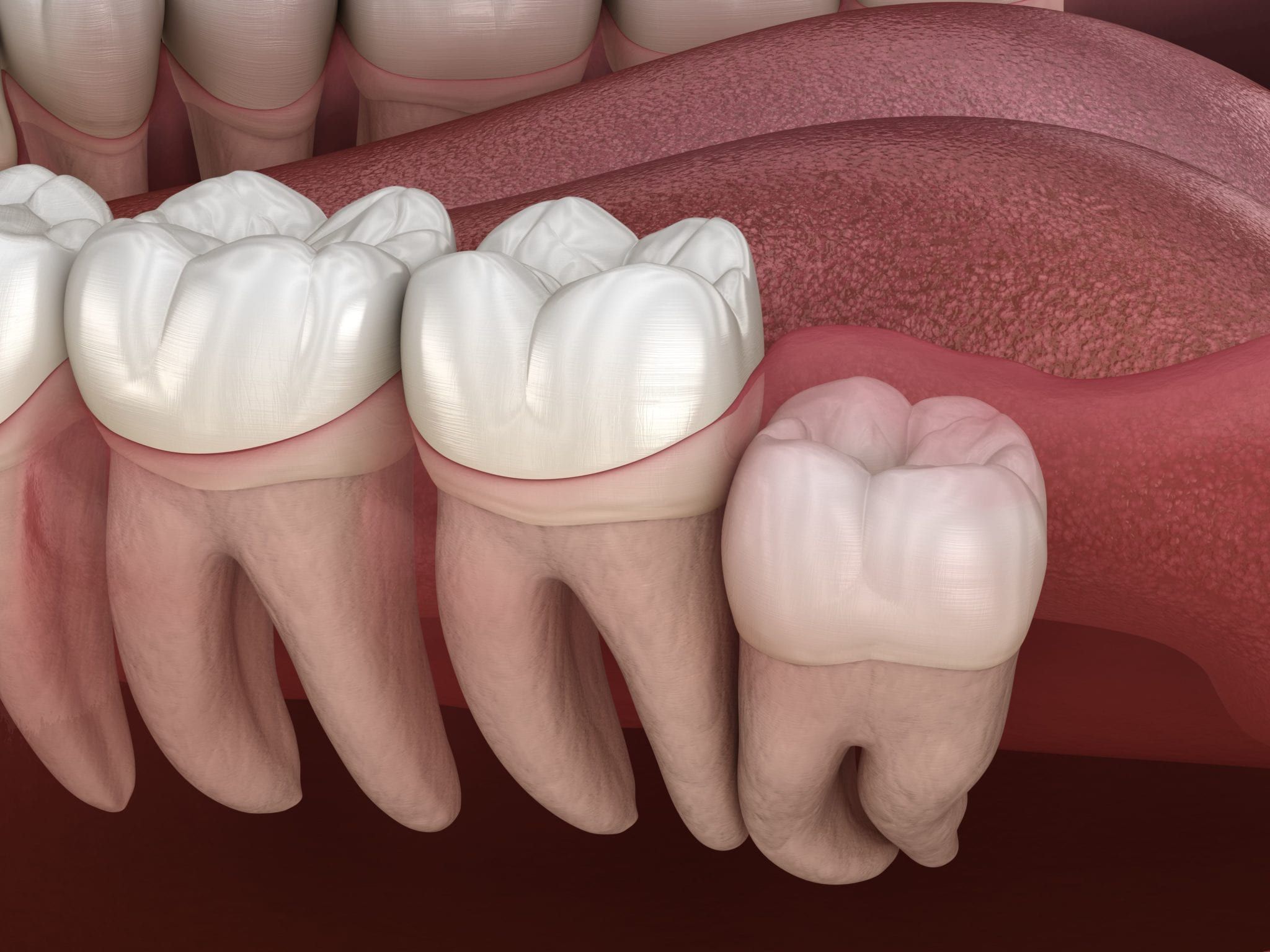3 Types of Wisdom Teeth Impaction - Tulsa Precision Dental